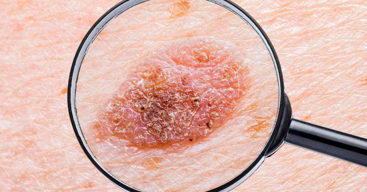 Tratamento Eficaz para Câncer de Pele na Cabeça e Pescoço
